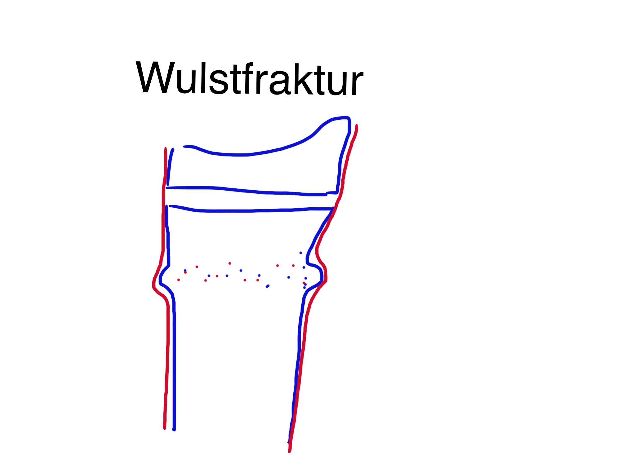 Knochenbrüche – www.bonekids.de